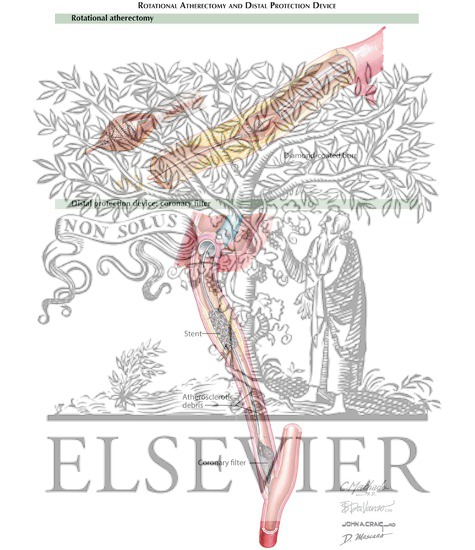 Chronic Angina Revascularization Procedures: Rotational Atherectomy and ...