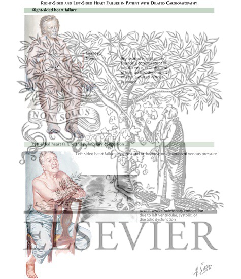 Right-Sided and Left-Sided Heart Failure in Dilated Cardiomyopathy and ...