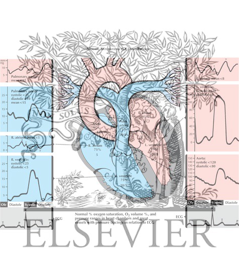 Cardiac Catheterization - Normal Oxygen Pressure; Normal Intracardiac ...
