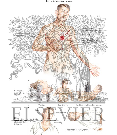 Pain of Myocardial Ischemia