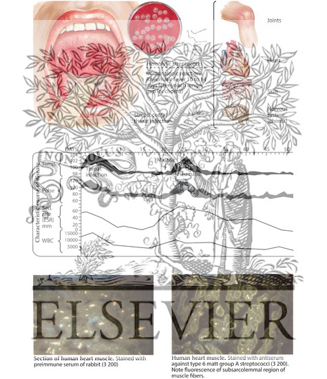 Rheumatic Fever; Sydenham's Chorea