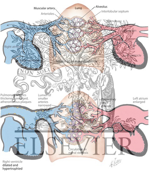 Rheumatic Heart Disease VI-Mitral Stenosis: Secondary Pulmonary Effects