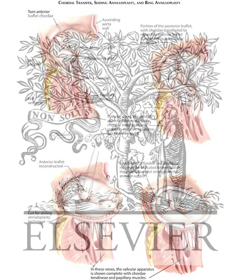 Chordal Transfer, Sliding Annuloplasty, and Ring Annuloplasty