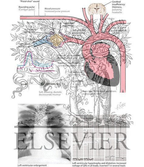 Aortic Insufficiency Manifestations of Aortic Insufficiency Valvular ...