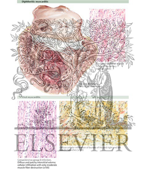 Diphtheritic and Viral Myocarditis