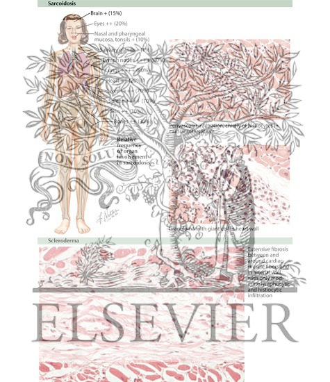 Myocarditis In Sarcoidosis and Scleroderma