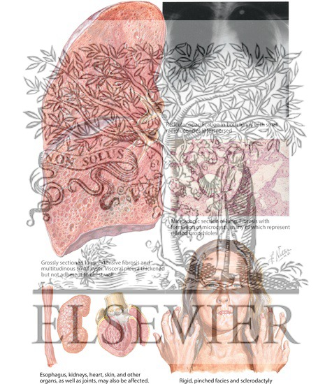 Progressive Systemic Sclerosis (PSS; Scleroderma); Lung Involvement