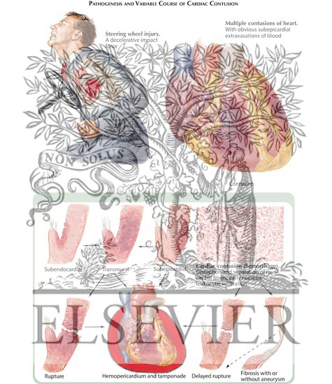 Nonpenetrating Heart Wounds