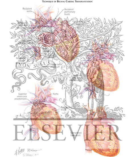 Technique of Bicaval Cardiac Transplantation