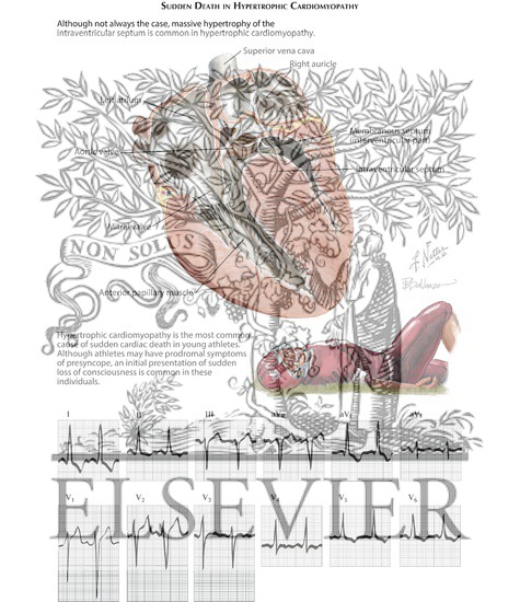Sudden Death In Hypertrophic Cardiomyopathy