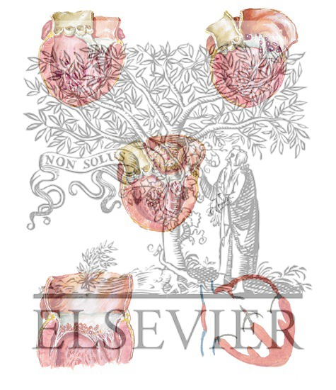 Uncommon Cardiac Mechanisms In Stroke