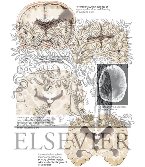 Brain Malformations