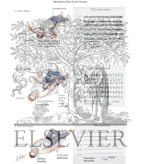 Generalized Tonic-Clonic Seizures