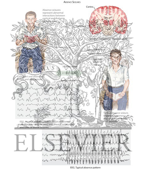 Absence Seizures