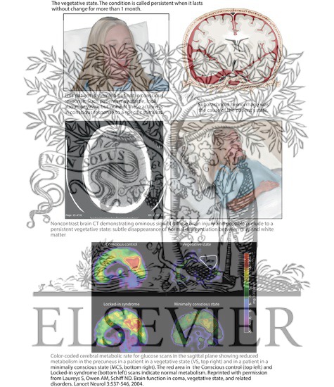 Persistent Vegetative State