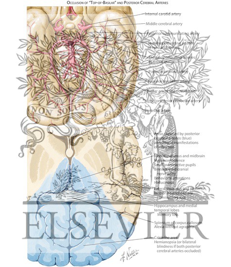Bilateral Basilar Occlusion