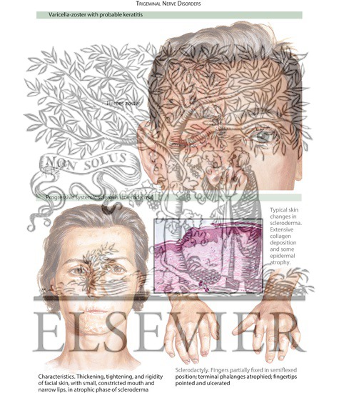 Trigeminal Nerve Disorders