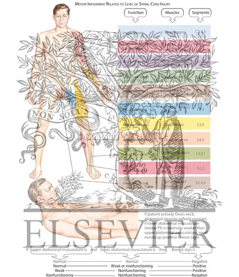 Motor Impairment Related to Level of Spinal Cord Injury