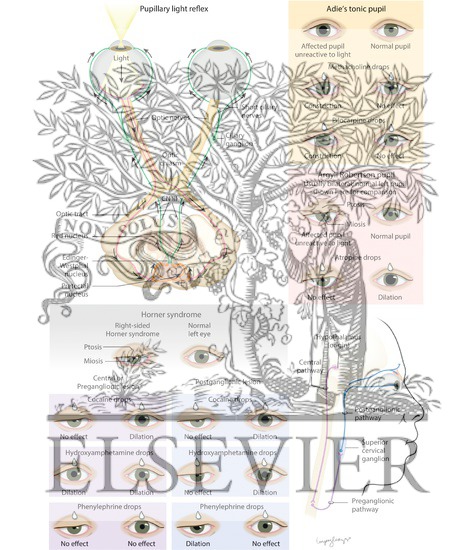 Abnormal Pupillary Conditions