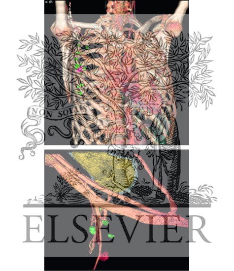 Lymph Nodes of the Axilla (Continued)