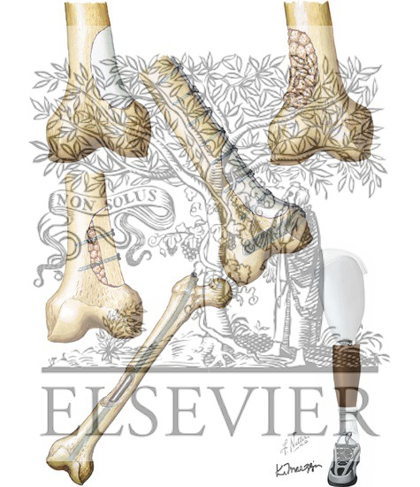 Reconstruction after Partial Excision or Curettage of Bone (Fracture ...