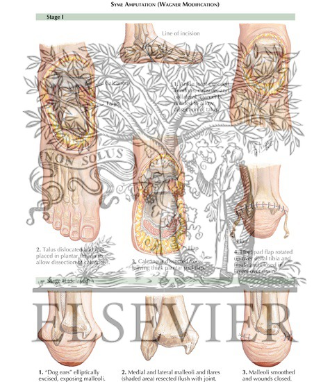 Syme Amputation (Wagner Modification)