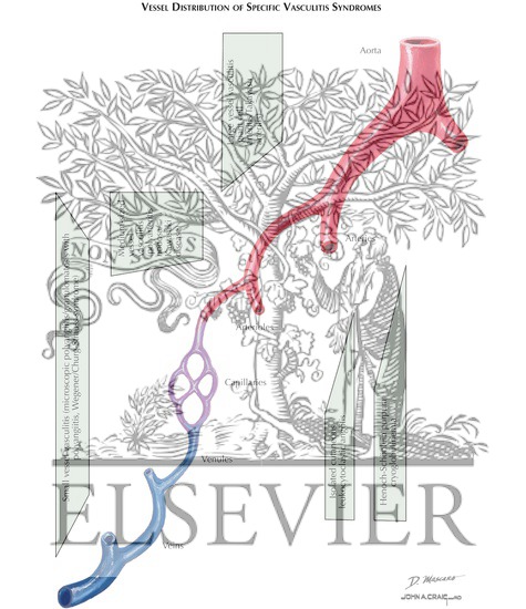 Vasculitis: Vessel Distribution