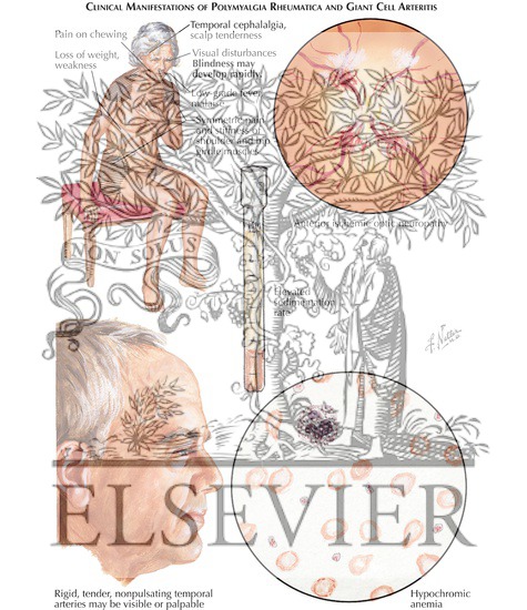 Giant-Cell (Temporal) Arteritis, Polymyalgia Rheumatica