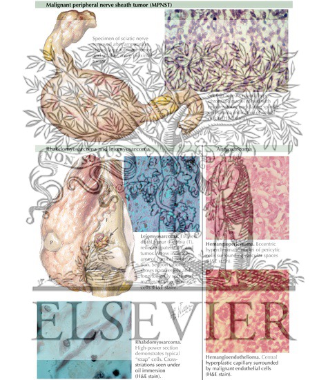Neurosarcoma, Myosarcoma, Angiosarcoma