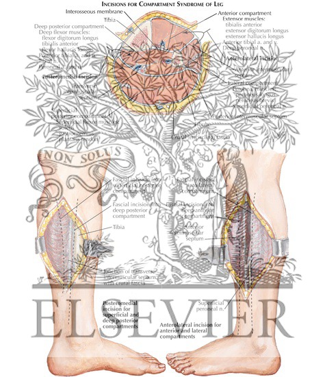 Incisions for Compartment Syndrome of Leg