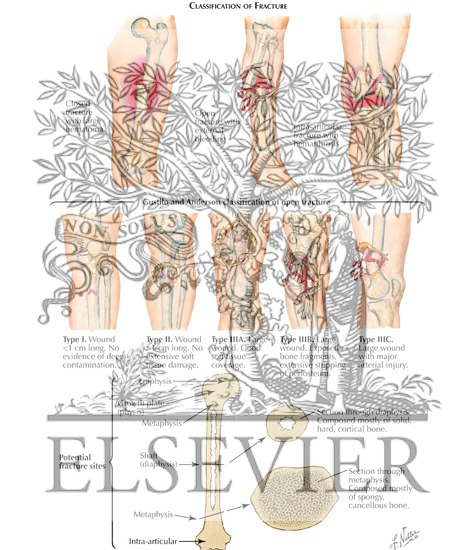Classification of Leg and Knee Fracture