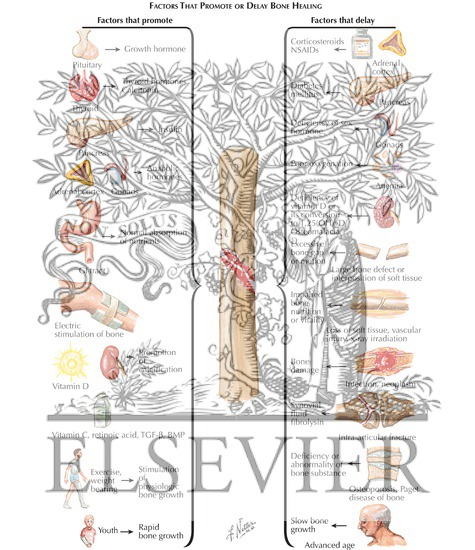 Factors That Promote or Delay Bone Healing