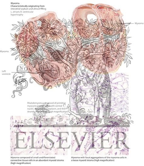 Primary Heart Tumors