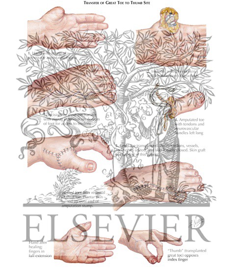 Transfer of Great Toe to Thumb