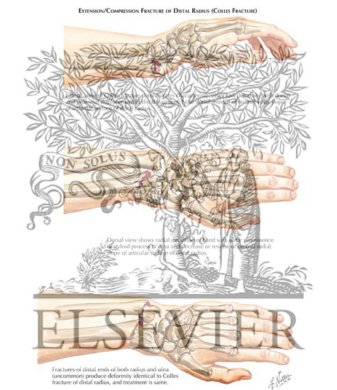 Extension/Compression Fracture of Distal Radius (Colles Fracture)