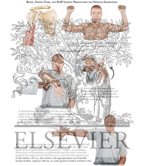 Biceps, Tendon Tears, and SLAP Lesions: Presentation and Physical ...