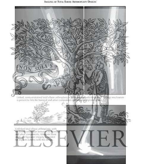 Arthritis: Imaging of Total Elbow Arthroplasty Designs