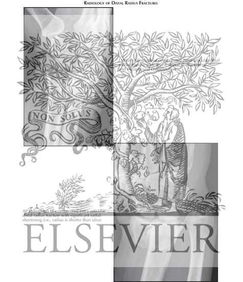 Fracture of Distal Radius: Radiology