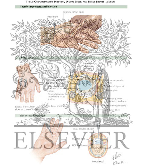 Thumb CMC Injection, Digital Block, and Flexor Sheath Injection