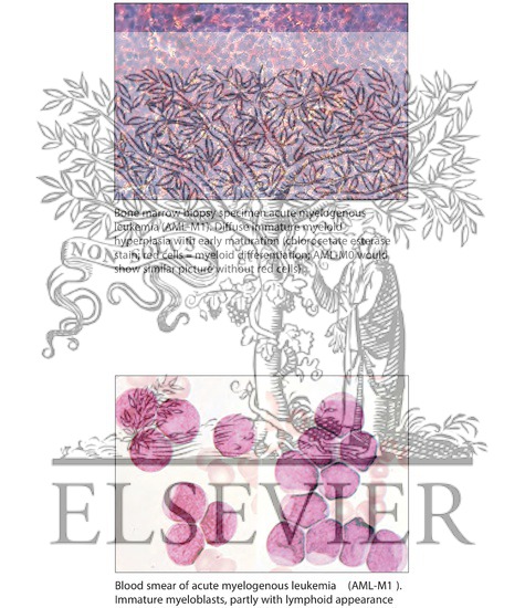 Acute Myelogenous Leukemia Subtypes M0, M1, and M2