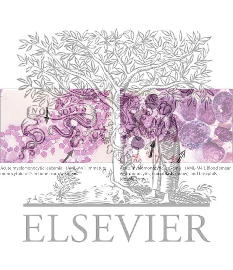 Acute Myelomonocytic Leukemia Subtypes M4 and M5
