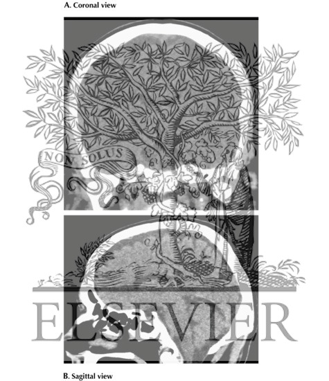 Brain Imaging: Computed Tomography Scans, Coronal and Sagittal