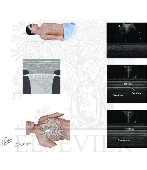 E-FAST Thoracic Examination