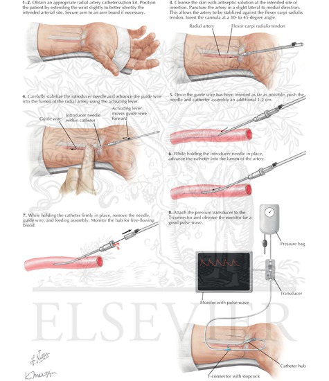 Radial Arterial Line