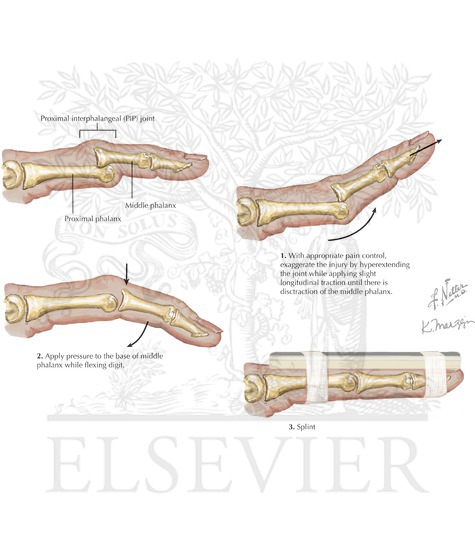 Dislocated Finger Reduction Reduction Of Proximal Int - vrogue.co Dislocated Finger Reduction Reduction Of Proximal Int - vrogue.co