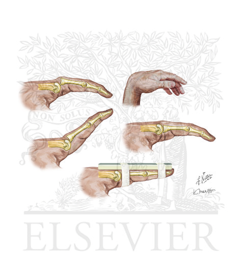 Dislocated finger reduction: metacarpophalangeal dislocations Dislocated finger reduction: metacarpophalangeal dislocations