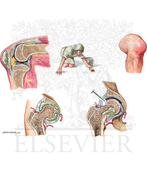 Septic Bursitis and Arthritis