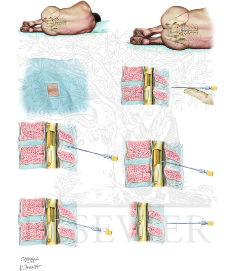 lumbar puncture cpt code