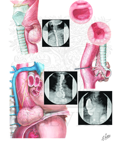 traction diverticulum