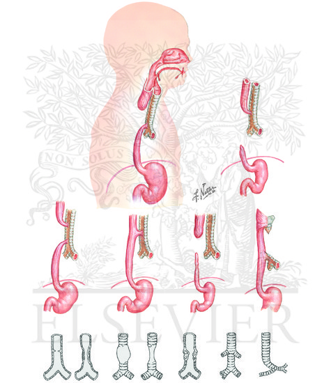 Esophageal Atresia